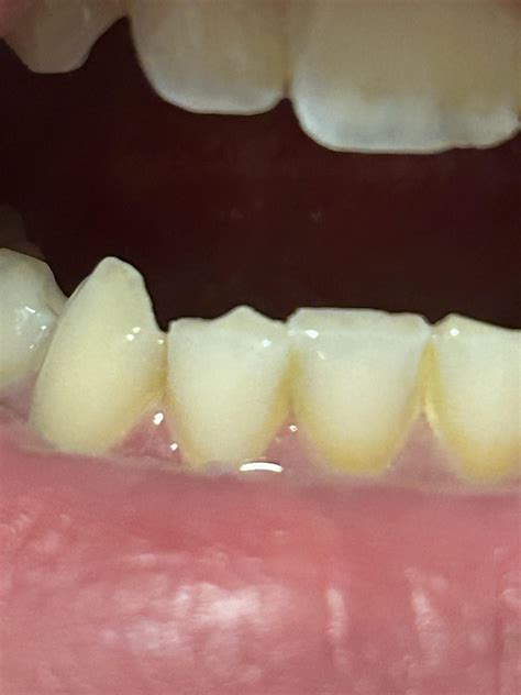 Chipped Tooth R Teethcare