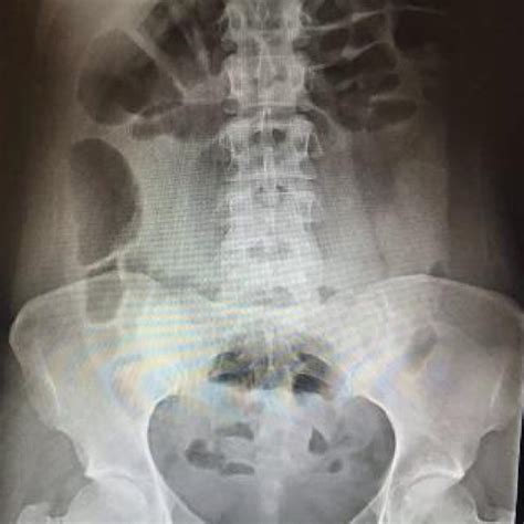 Pdf Post Polypectomy Syndrome Presenting With “micro Perforation” And