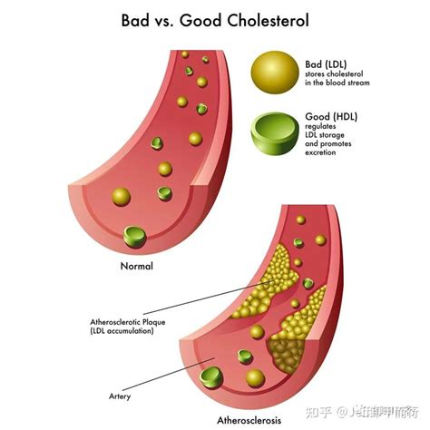 9 15：血脂（胆固醇）代谢异常与甲状腺癌风险 知乎