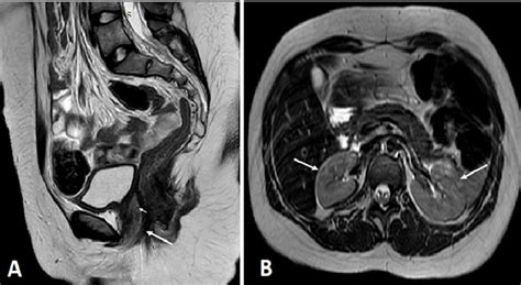 Pelvic Mri T2 Weighted Sagittal Plane A Revealed Uterine Cervix