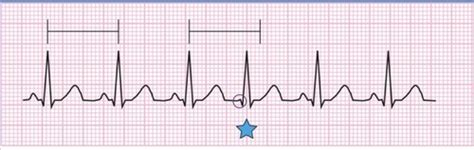 Ekg Sinus Node Dysfunction To Heart Blocks Flashcards Quizlet
