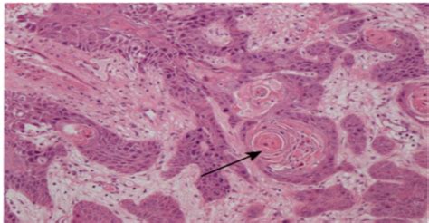 Malignant Lung Pathology Flashcards Quizlet