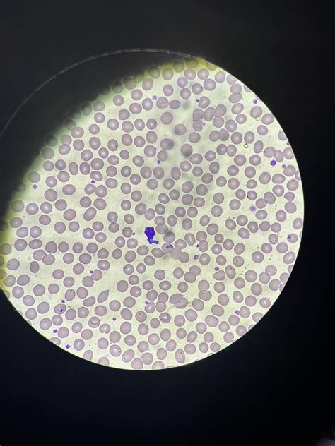 Reactive Lymph Rmedlabprofessionals