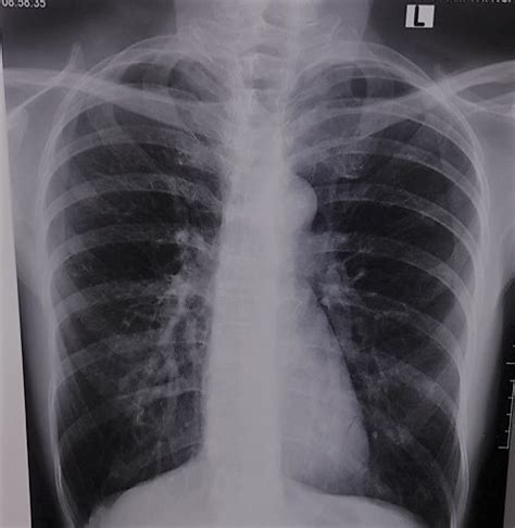 Vietnamese Medic Ultrasound Case 676 Lung Tumor Or Tb Lung Dr Phan