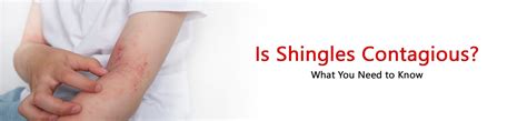 Is Shingles Contagious Essential Facts Every Adult Should Know