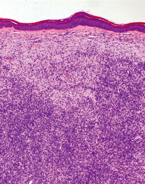 Dermatofibrosarcoma Protuberans Congénito Descripción De Un Caso Actas Dermo Sifiliográficas