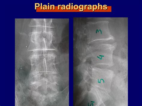 Spinal Epidural And Subdural Intramedullar Abscesses Ppt