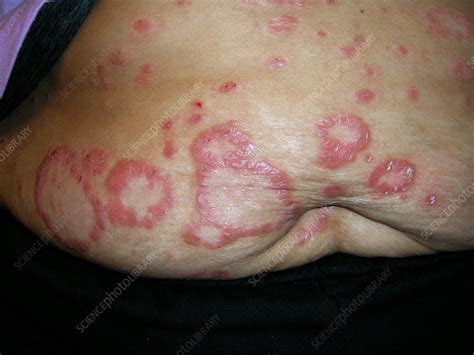 Annular Psoriasis Stock Image C0565014 Science Photo Library