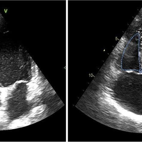 Global Right Ventricular Longitudinal Strain Rvls To Perform The