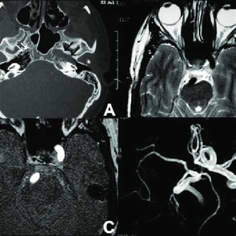 Patient 4 Ct Scan Of The Temporal Bones With Bone Settings Figure 6a