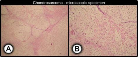 Pathological Specimen From Chondrosarcoma Grade 2 A Note The