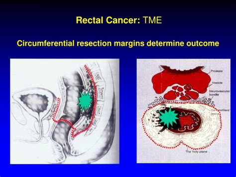Ppt T Staging Rectal Cancer Powerpoint Presentation Free Download