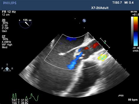 Tee Picture Of Long Access View Of The Aortic Valve Showing Mild Aortic Download Scientific