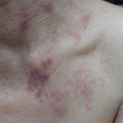 Female Patient With Zosteriform Rash On Her Nape Of The Neck Download