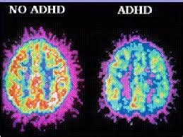 Addadhd Bills Views On Most Everything