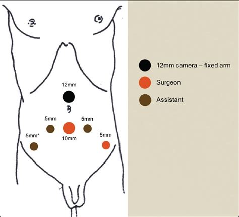 Appendicovesicostomy