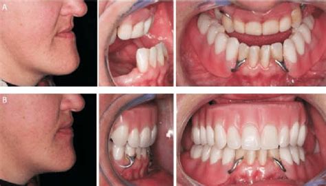 A Intraoral And Extraoral View Of The Maxillary Orpd And The