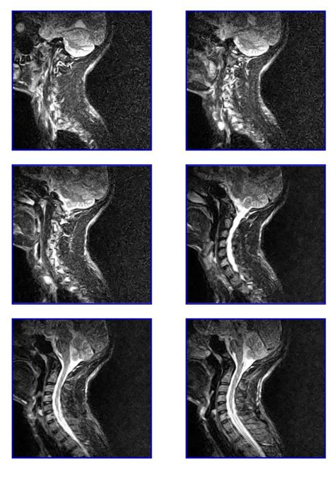 Nerve Or Spine Compression Rspinesurgery