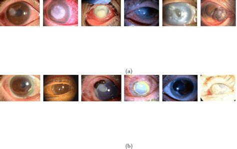 Automated Eye Disease Classification Method From Anterior Eye Image Using Anatomical Structure