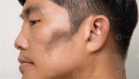 Close Up Of Melasma On Cheekbone With Gray Brown Patch Skin