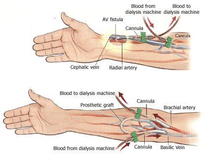 Dialysis Fistula
