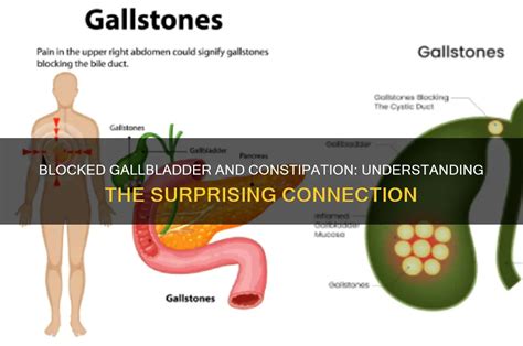 Blocked Gallbladder And Constipation Understanding The Surprising Connection Medshun