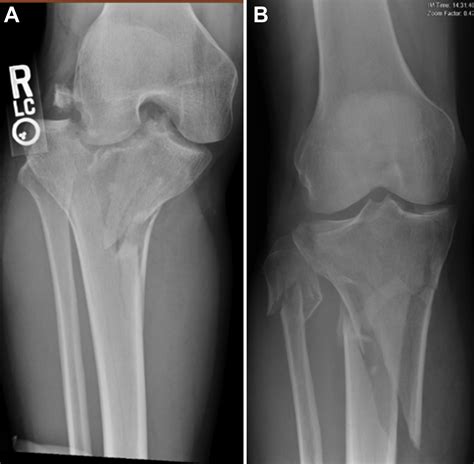 Bicondylar Tibial Plateau Fracture
