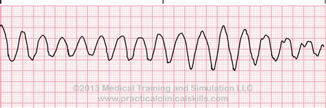 Conduction Disorders Pearls Smarty Pance
