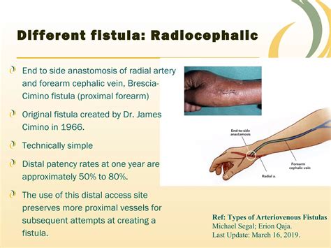 Vascular Access For Dialysis Access Seminar Ppt