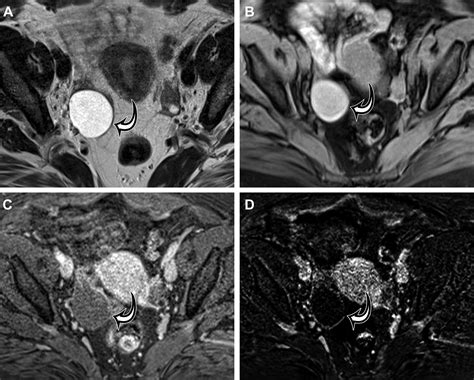 Mr Imaging Of The Ovaries Magnetic Resonance Imaging Clinics