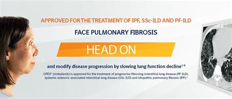 Fsinoptimizing Treatment Of Patients With Pf Ild With Patient Case