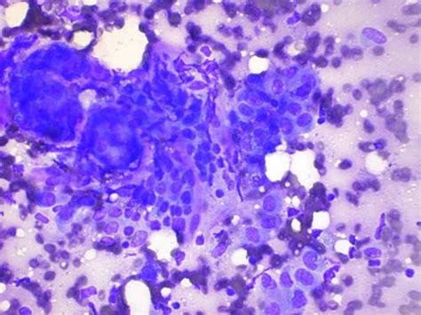 Diff Quik Stain ×400 Fna Smear From The Breast Mass Showing A Download Scientific Diagram