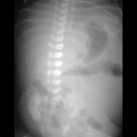 Newborn With Bilious Residuals From The Nasogastric Tube Pediatric