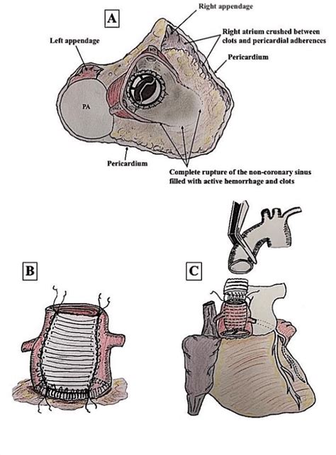 A Illustration Of The Aortic Root Showing A Complete Rupture Of The Download Scientific
