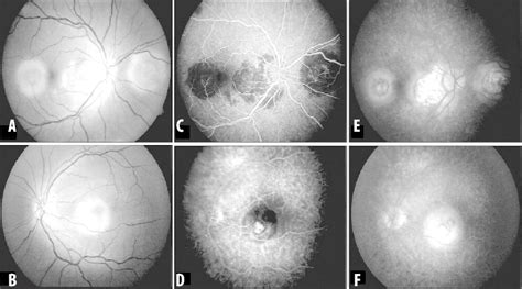 A B Red Free Fundus Photographs Of Round Subretinal Grayish Yellow