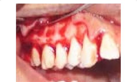 Flap Elevation On Labial Aspect Download Scientific Diagram