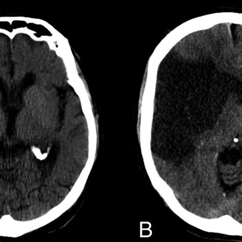 Large Mca Infarct On Follow Up With And Without Prominent