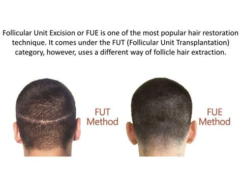 Ppt Advantages And Disadvantages Of Follicular Unit Excision Powerpoint Presentation Id 8112743