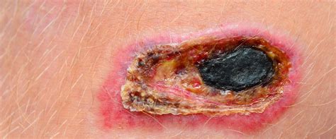 Eschar Wound