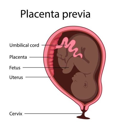 80 Background Of The Pregnant Uterus Diagram Stock Illustrations