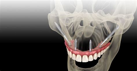 Implantologia Zigomatica Soluzione Per Chi Ha Ridotta Densità Ossea