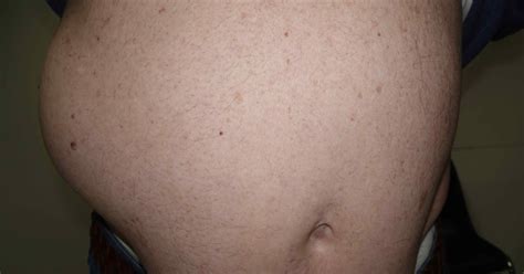 Dermapixel Un Herpes Y Un Bulto En La Barriga
