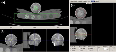 Quantitative Computed Tomography Qct In The Steps A Extraction B Download Scientific Diagram