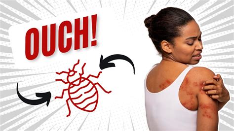 Bed Bug Bites On Black People Close Up Pictures Of Bedbug Bites And