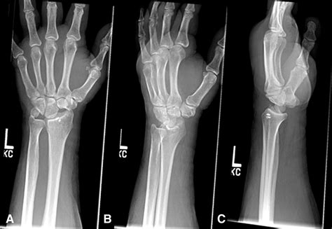 Complete Anterior Scaphoid Expulsion In Transscaphoid Lunate Dislocation In An Adult Male After