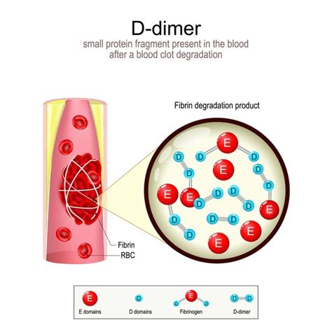 D Dimer Pulmonary Embolism Over 1 Royalty Free Licensable Stock