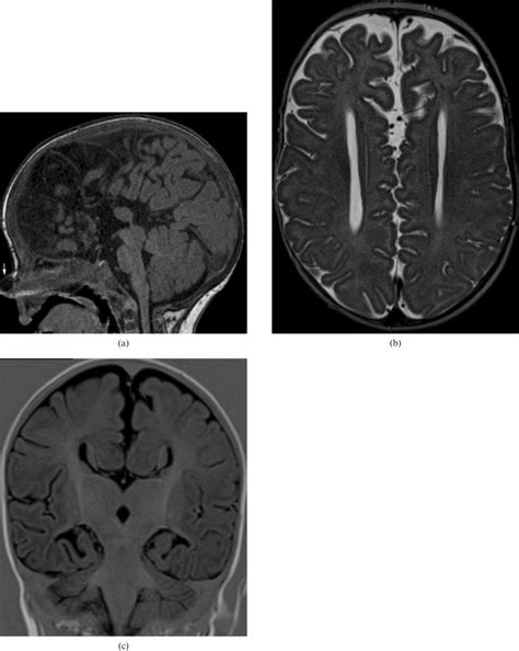 The Corpus Callosum White Matter Or Terra Incognita Pmc