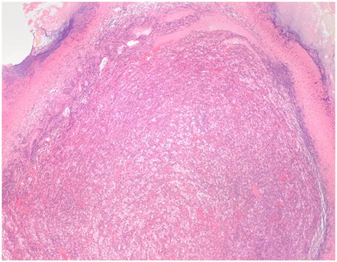 Low Power View 40× Magnification Of A Cellular Nodule Within The Download Scientific Diagram