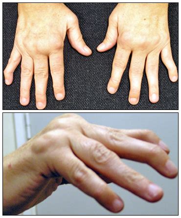 Rheumatoid Arthritis Hands Early Signs