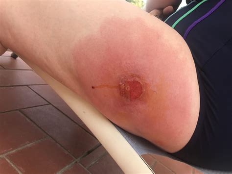 Bug Bite Vs Staph Infection